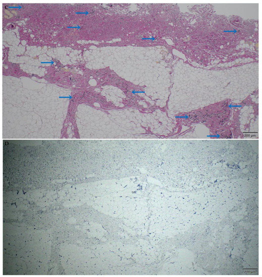 Management of Axillary Contracture in Poland Syndrome: Differentiating ...