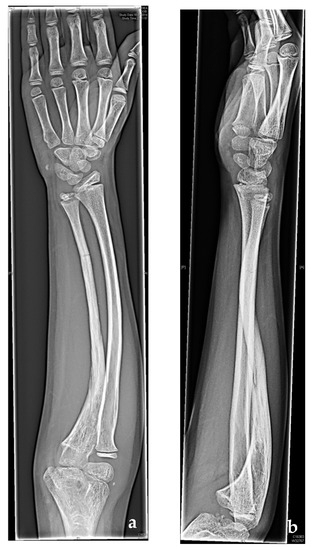 Vascularized Growth Plate Transfer in Paediatric Ulna Non-Union ...