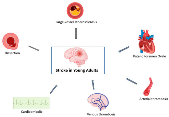 Stroke in Young Adults
