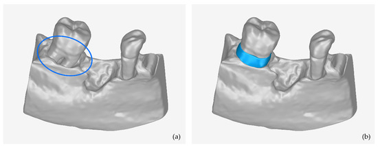 CBCT-Based Design of Patient-Specific 3D Bone Grafts for Periodontal ...
