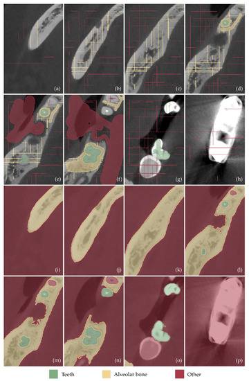 CBCT-Based Design of Patient-Specific 3D Bone Grafts for Periodontal ...