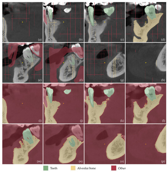 CBCT-Based Design of Patient-Specific 3D Bone Grafts for Periodontal ...