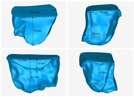 CBCT-Based Design of Patient-Specific 3D Bone Grafts for Periodontal ...