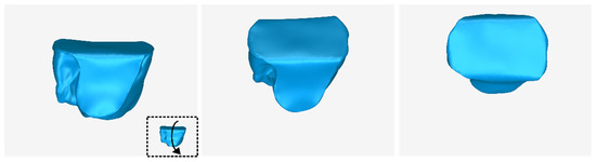 CBCT-Based Design of Patient-Specific 3D Bone Grafts for Periodontal ...