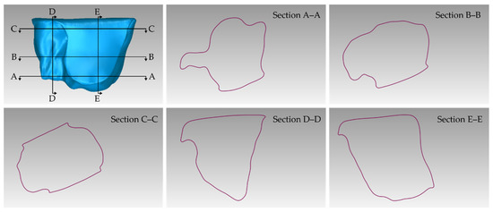 CBCT-Based Design of Patient-Specific 3D Bone Grafts for Periodontal ...