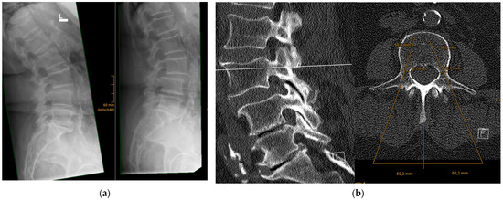 Free-Hand MIS TLIF without 3D Navigation—How to Achieve Low Radiation ...