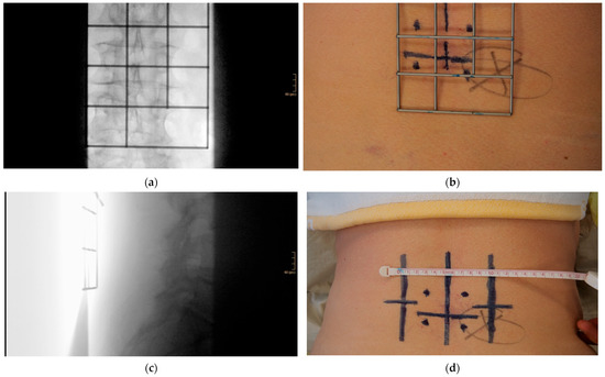 Free-Hand MIS TLIF without 3D Navigation—How to Achieve Low Radiation ...