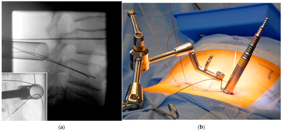 Free-Hand MIS TLIF without 3D Navigation—How to Achieve Low Radiation ...