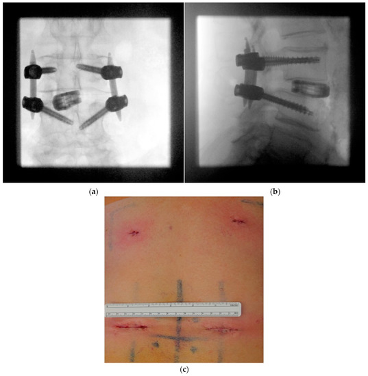 Free-Hand MIS TLIF without 3D Navigation—How to Achieve Low Radiation ...