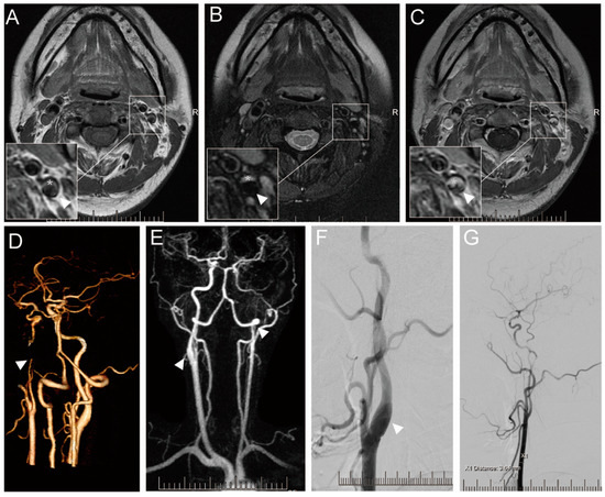 Unraveling the Links between Chronic Inflammation, Autoimmunity, and ...