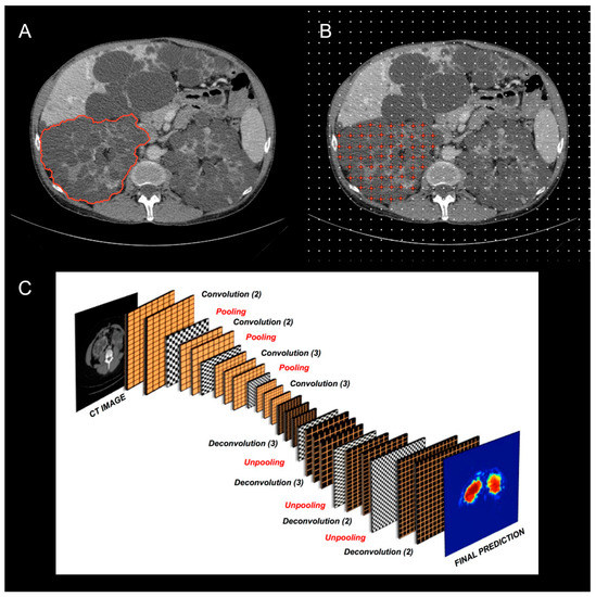 Abdominal Imaging in ADPKD: Beyond Total Kidney Volume