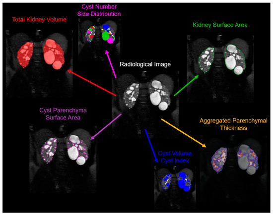 Abdominal Imaging in ADPKD: Beyond Total Kidney Volume