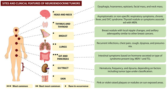 A Comprehensive Review on Neuroendocrine Neoplasms: Presentation ...