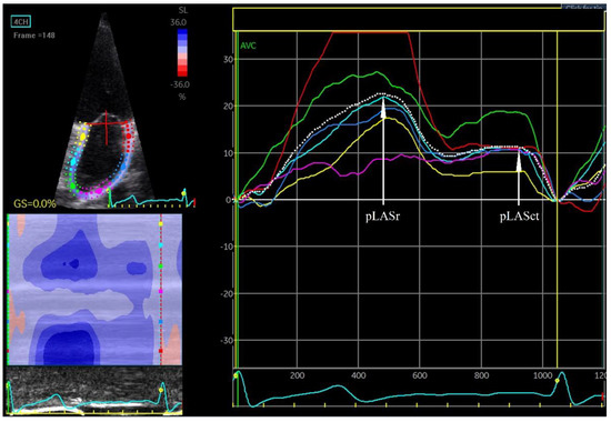 JCM | Free Full-Text | Echocardiographic Evaluation of Atrial ...