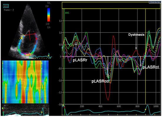 JCM | Free Full-Text | Echocardiographic Evaluation of Atrial ...