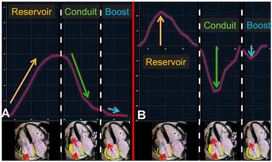 Right Atrial Phasic Function in Heart Failure with Preserved Ejection Fraction: Cardiac Magnetic ...
