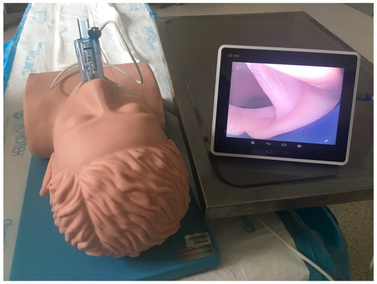Supraglottic Airway Devices with Vision Guided Systems: Third ...