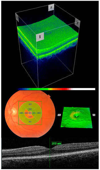 Normative Data for Macular Thickness and Volume for Optical Coherence ...