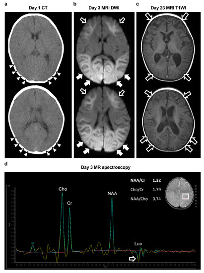 Infantile Hypoxic Encephalopathy Mimicking Acute Encephalopathy with ...