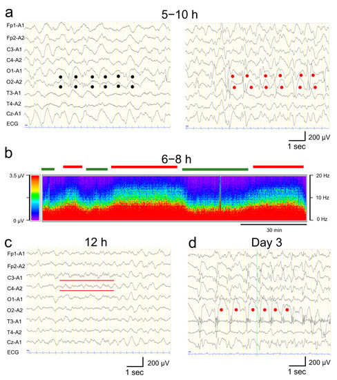 Infantile Hypoxic Encephalopathy Mimicking Acute Encephalopathy with ...