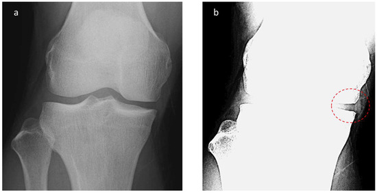 Evaluation of Medial Meniscal Extrusion Using Radiography