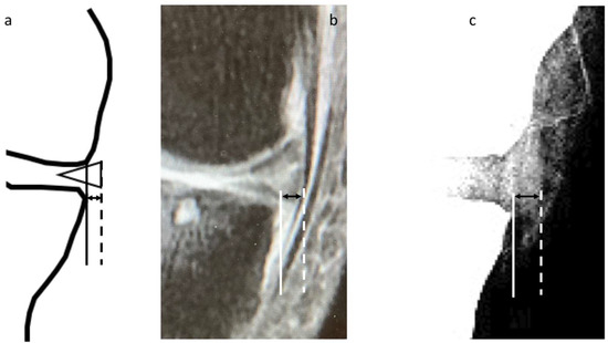 Evaluation of Medial Meniscal Extrusion Using Radiography