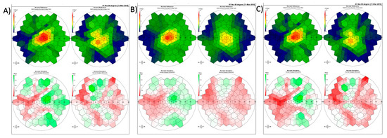 Effects of Smoothing and Adaptive Filtering in Multifocal ...