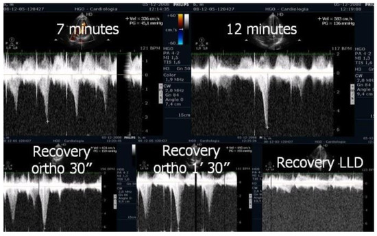 The Importance of Left Ventricular Outflow Tract and Mid-Ventricular ...