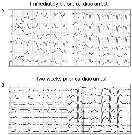 Cardiac Arrest as an Uncommon Manifestation of Late Type A Aortic ...