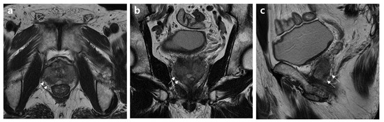Predictors of Extraprostatic Extension in Patients with Prostate Cancer