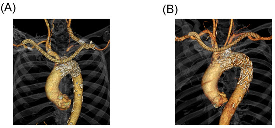 Assessment of the Effectiveness of Zone 1-Landing Hybrid TEVAR by ...