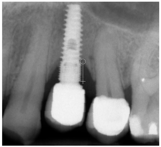 Is Corticalization in Radiographs Related to a Higher Risk of Bone Loss ...