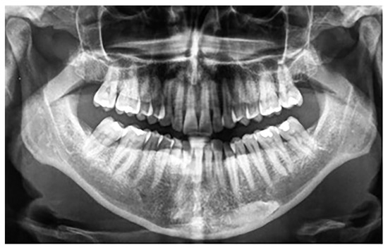Impacted Permanent Mandibular Canines: Epidemiological Evaluation
