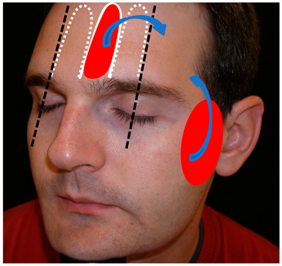 Simplifying Forehead and Temple Reconstruction: A Narrative Review