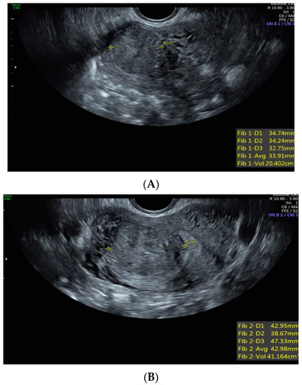 Investigating Fumarate Hydratase-Deficient Uterine Fibroids: A Case Series