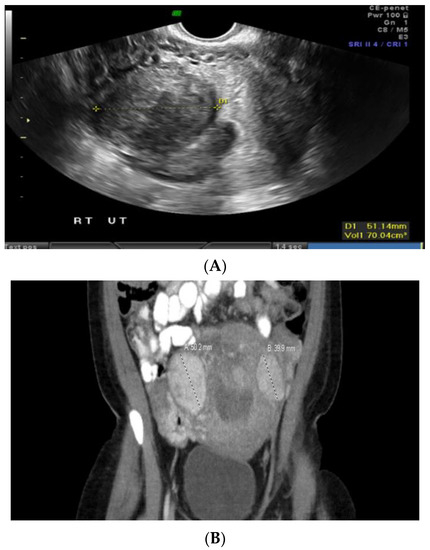 Investigating Fumarate Hydratase-Deficient Uterine Fibroids: A Case Series
