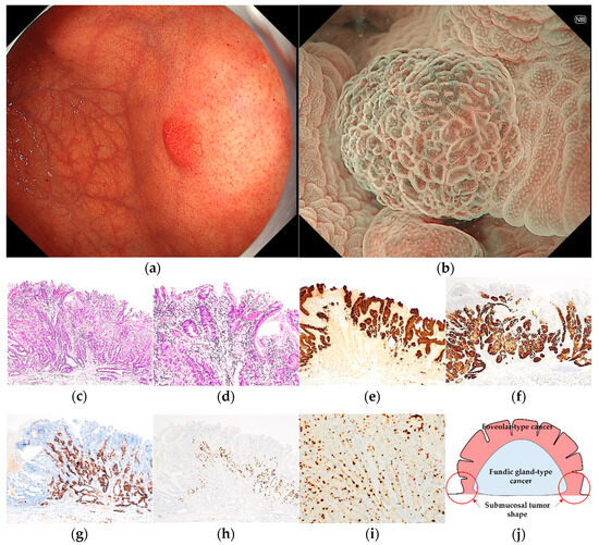 Endoscopic Diagnosis Strategy of Raspberry-Shaped Gastric Lesion in ...