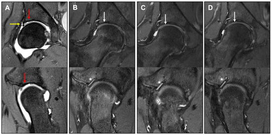 Two-Year Results of Injectable Matrix-Associated Autologous Chondrocyte ...