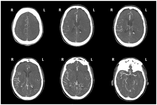Inter-Rater Reliability of Collateral Status Assessment Based on CT ...