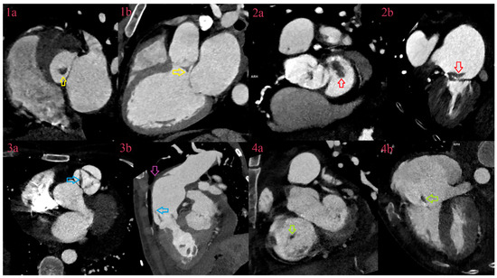 The Role of Echocardiography and Cardiac Computed Tomography in ...