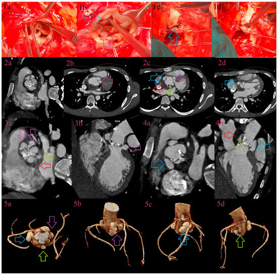 The Role of Echocardiography and Cardiac Computed Tomography in ...