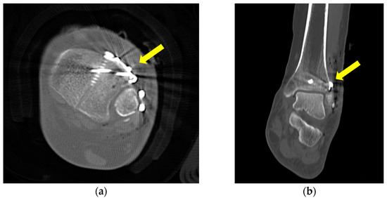 Evaluating the Efficacy of Tension Band Wiring Fixation for Chaput ...