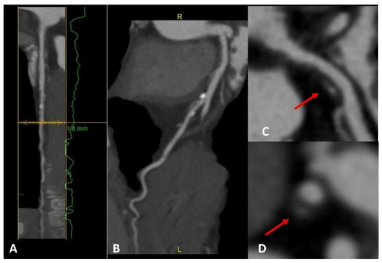 Role of Cardiovascular Imaging in Risk Assessment: Recent Advances ...
