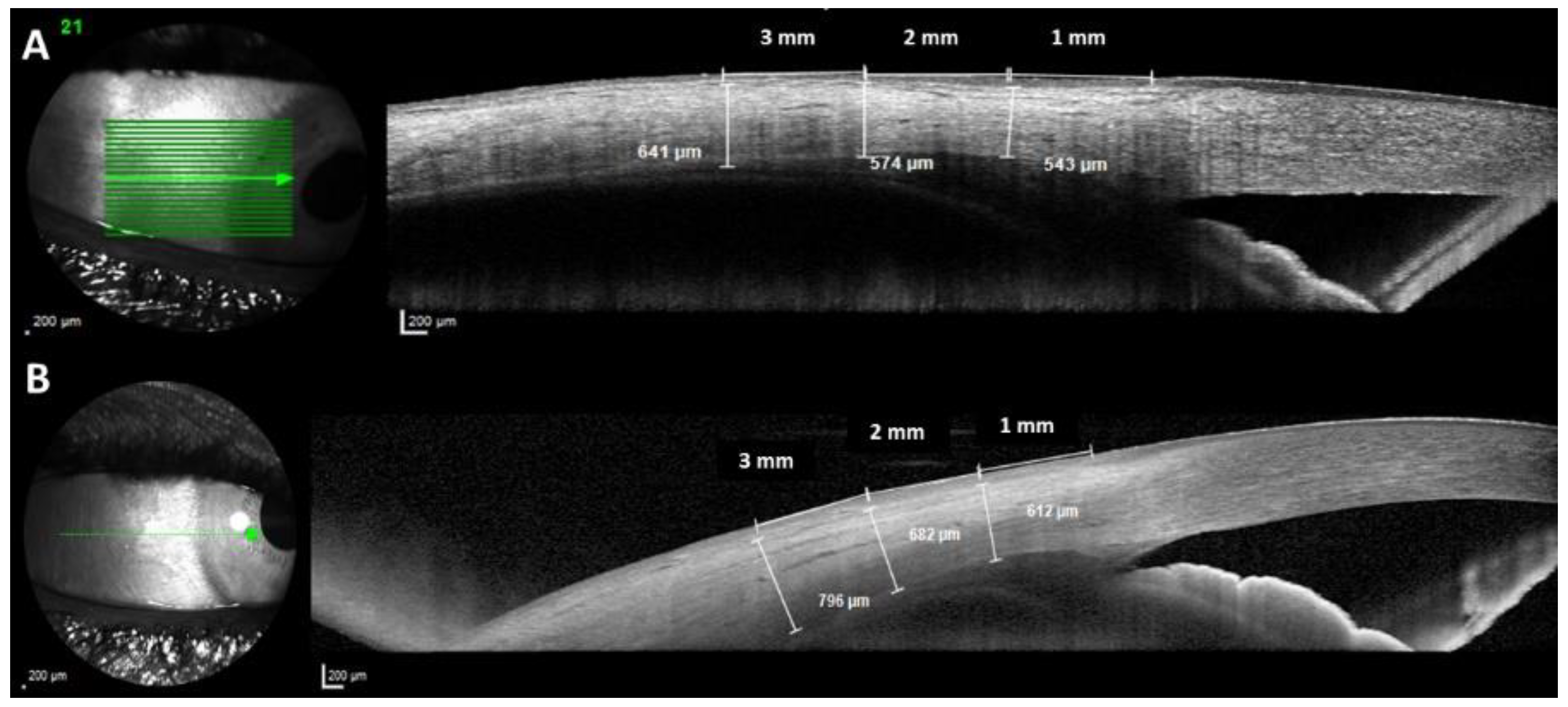 Anterior Scleral Thickness and Other Dimensions in Nanophthalmos by ...
