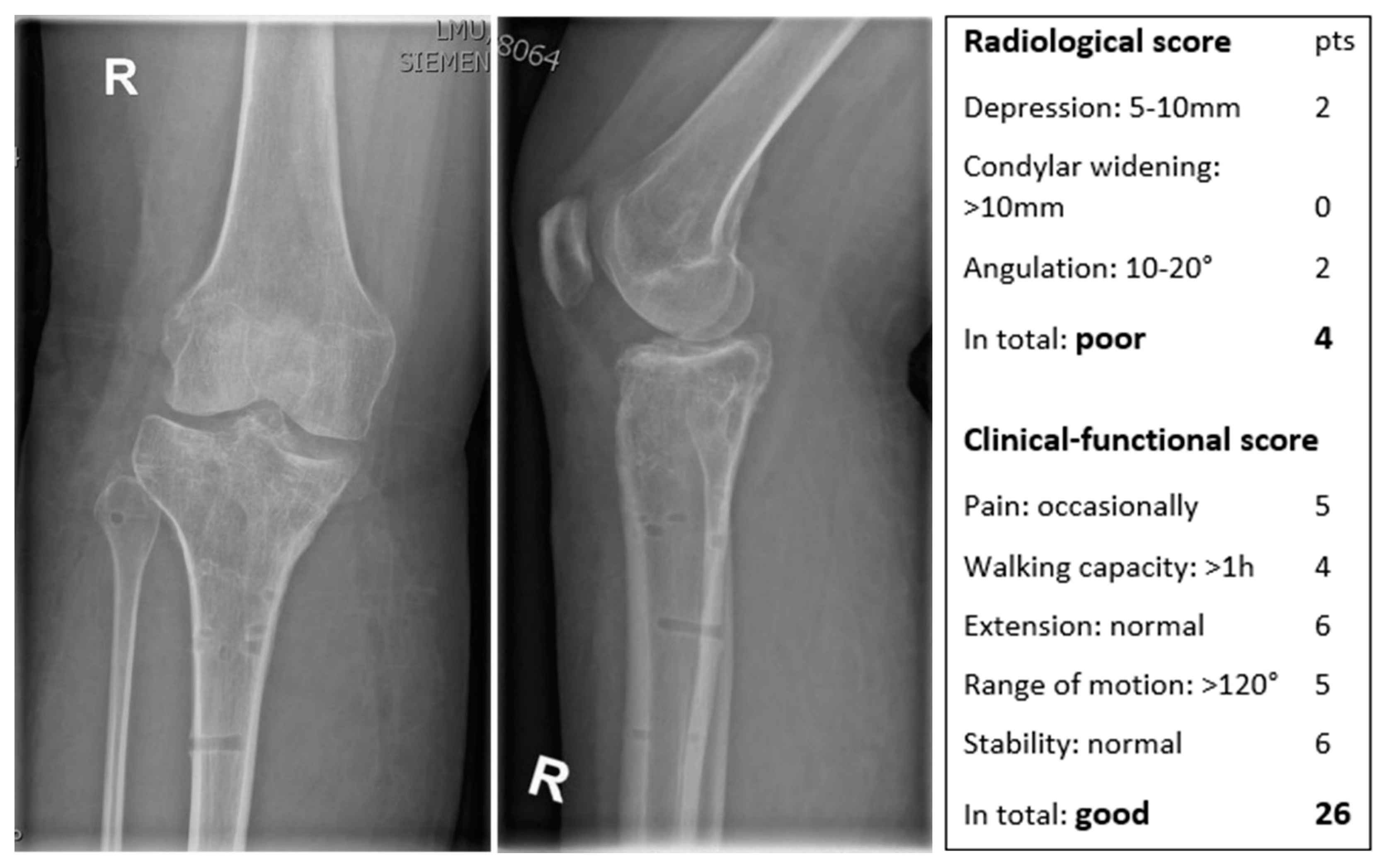 Mismatch between Clinical–Functional and Radiological Outcome in Tibial Plateau Fractures: A ...