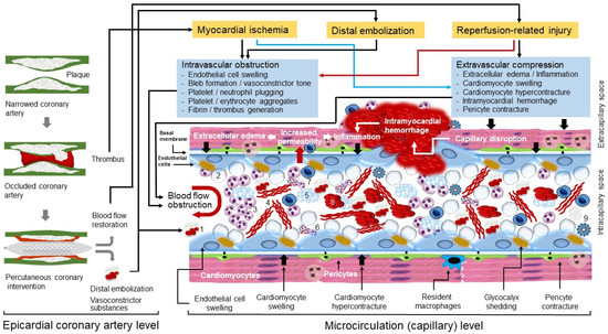 JCM | Free Full-Text | Coronary No-Reflow after Primary Percutaneous Coronary Intervention ...