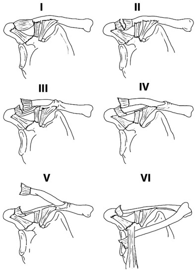 JCM | Free Full-Text | Acromioclavicular Joint Lesions in Adolescents—A ...