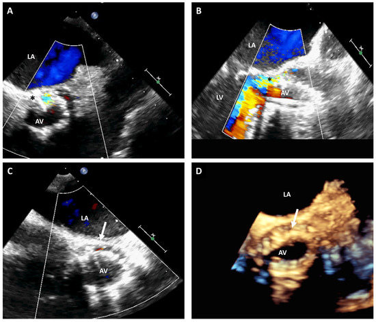 Three-Dimensional Transesophageal Echocardiography in Percutaneous ...