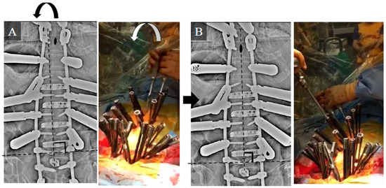 New Effective Intraoperative Techniques for the Prevention of Coronal ...