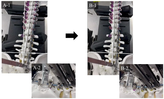 New Effective Intraoperative Techniques for the Prevention of Coronal ...